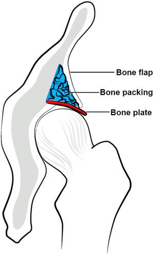 Acetabuloplasty Cincinnati | Pincer Impingement Treatment West Chester