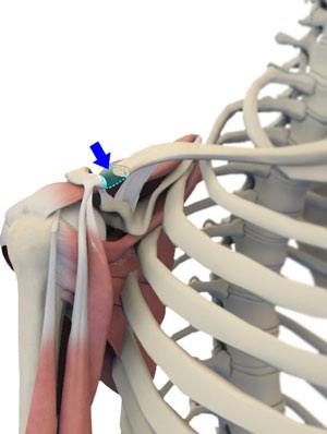 Distal Clavicle Excision Cincinnati | AC Joint Arthritis Treatment West ...